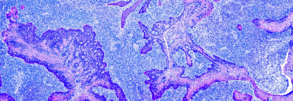 Adaptimmune Gets the Green Light for its New T-cell Cancer Therapy