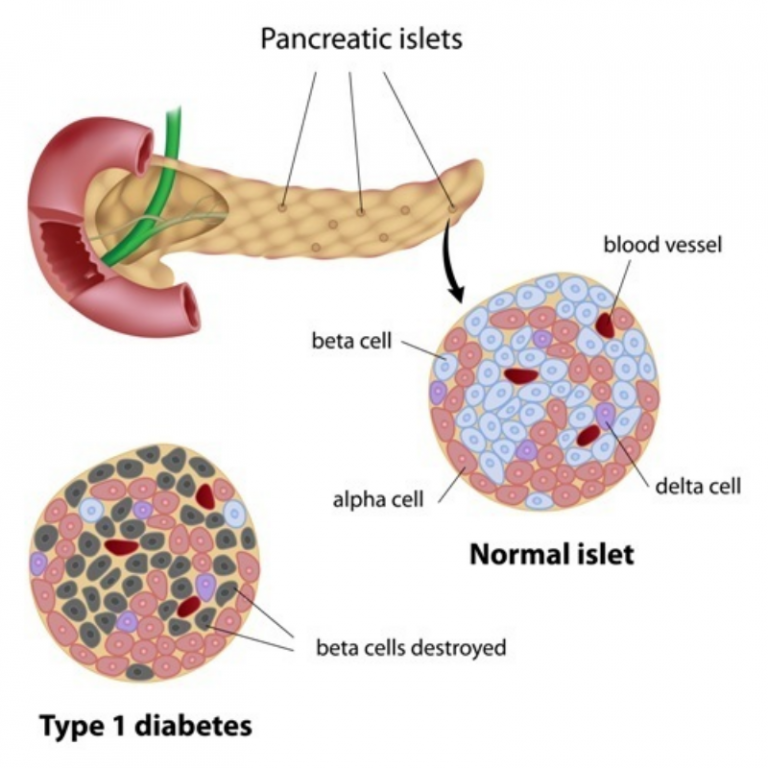 Swedish Researchers Find Pancreatic Islets Determine Ideal Blood Sugar ...