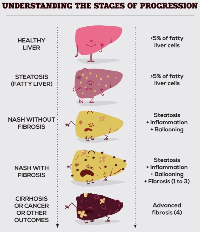 Liver Disease Progression Chart - vrogue.co Liver Disease Progression Chart - vrogue.co