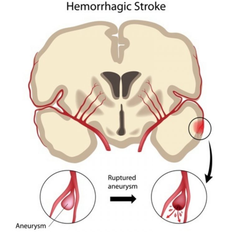 Idorsia Tackles Brain Artery Constriction Caused by Hemorrhage