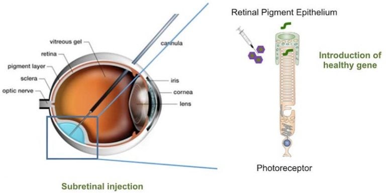 Gene Therapy for Retinitis Pigmentosa Tested in Humans for the First Time