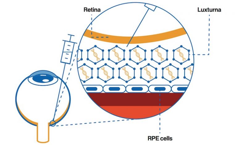 Luxturna, First Gene Therapy for Inherited Blindness, Approved in Europe
