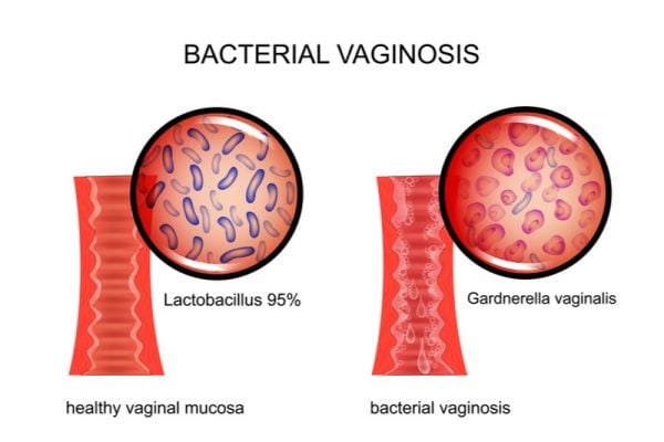 PhagoMed Biopharma Will Treat Bacterial Vaginosis with Viral Protein