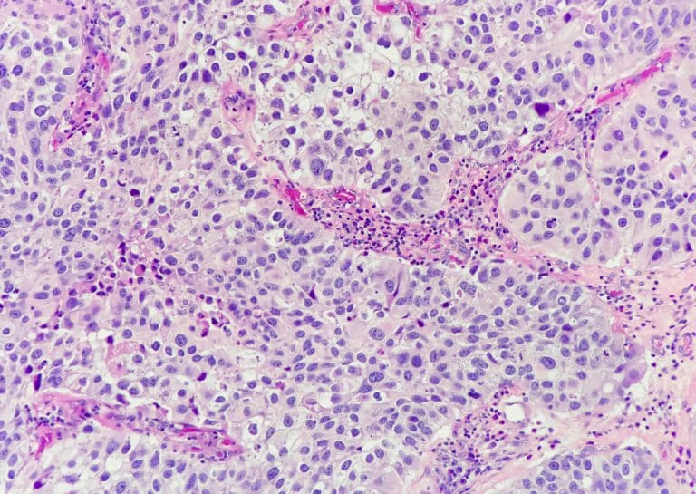 Astellas, Seagen and Merck give details on urothelial cancer treatment