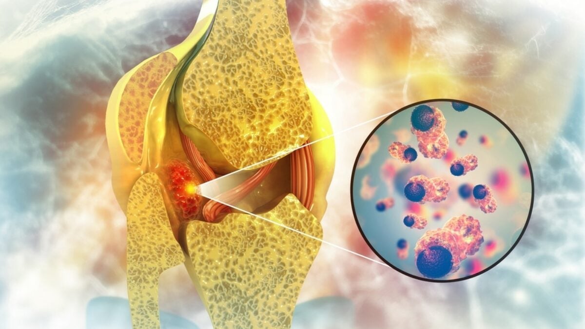 Promising Drug that works( Allegedly) on all types of Bone Cancer ...